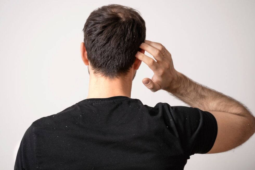 Les Premiers Signes D'un Début De Calvitie - Men's Shampoo
