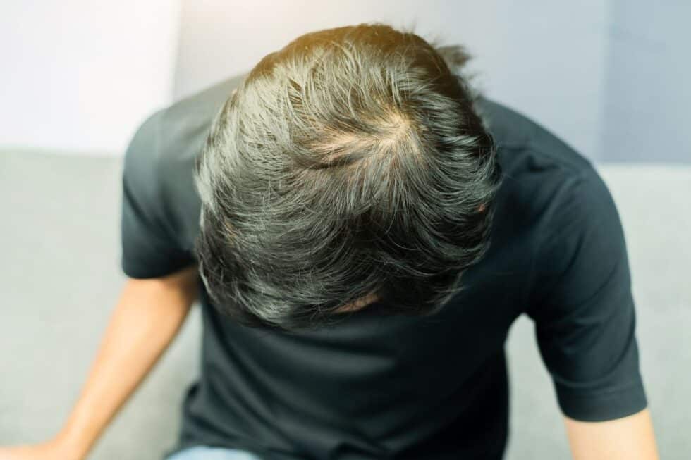 8 Astuces Pour Prendre Soin D'une Calvitie Naissante ! - Men's Shampoo