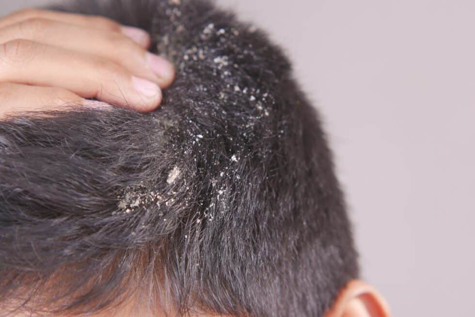 Les Meilleurs Shampoings Dermatologiques Pour Le Psoriasis Du Cuir Chevelu